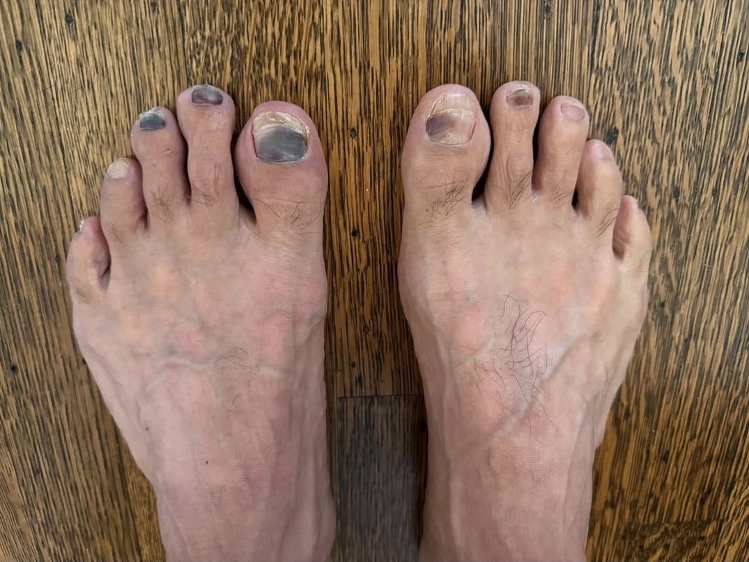 독립유공자 위해 81.5km 뛴 션…만신창이 된 발 사진 뒤늦게 공개